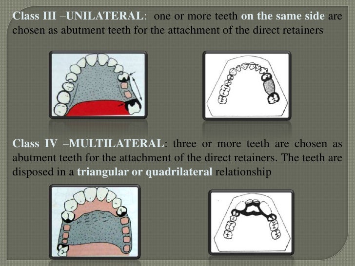 Classification of rpd