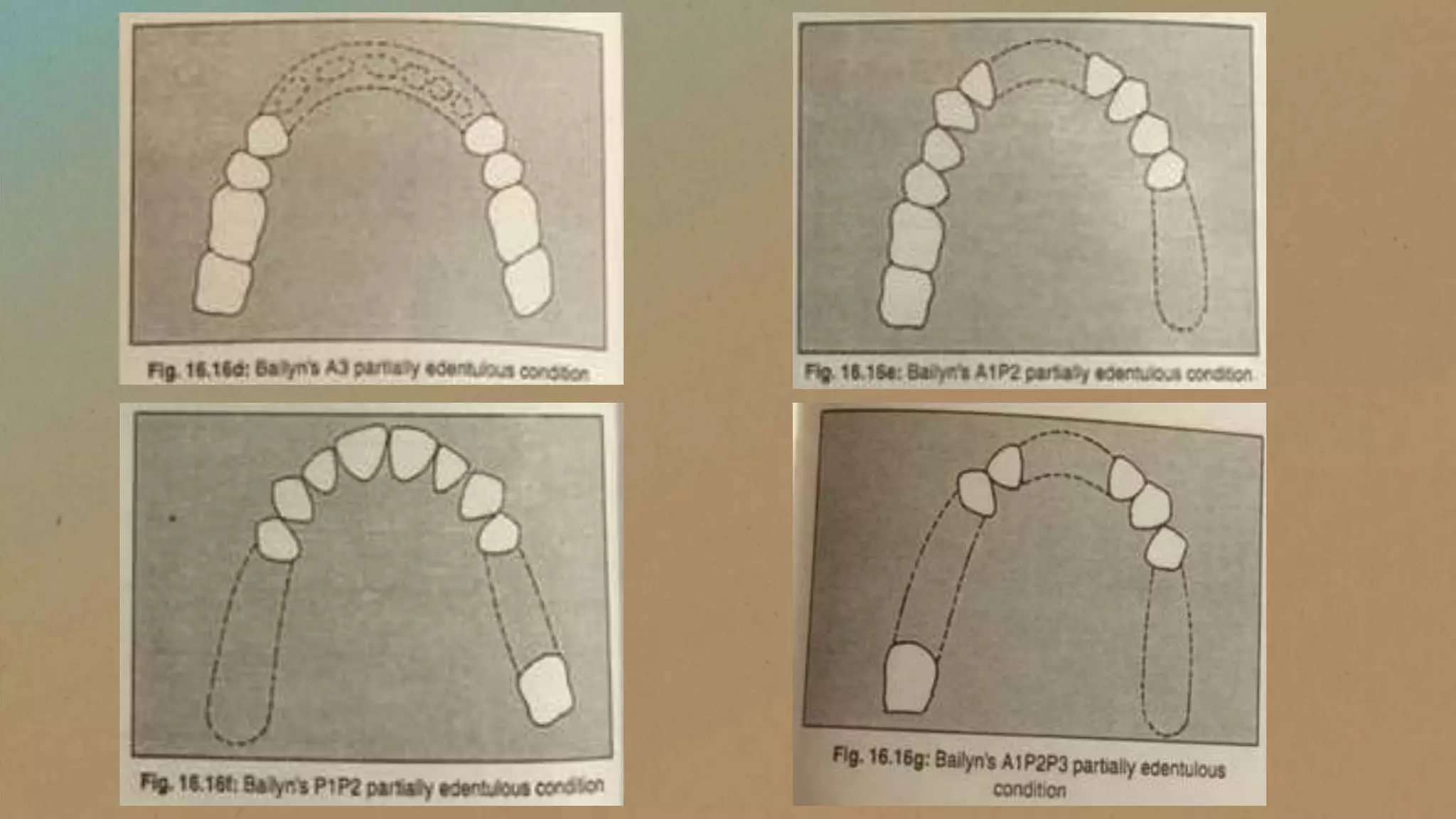 Classification of rpd (lecture) | PPSX