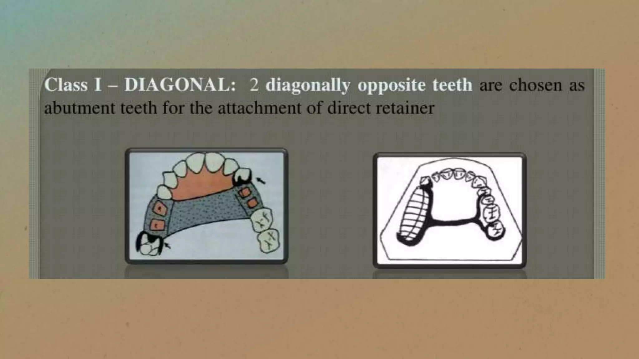 Classification of rpd (lecture) | PPSX