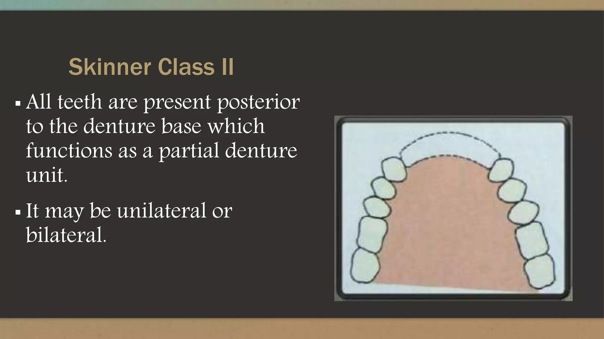 Classification of rpd (lecture) | PPSX