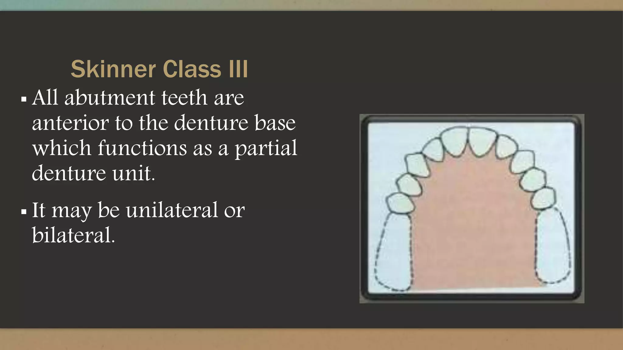 Classification of rpd (lecture) | PPSX