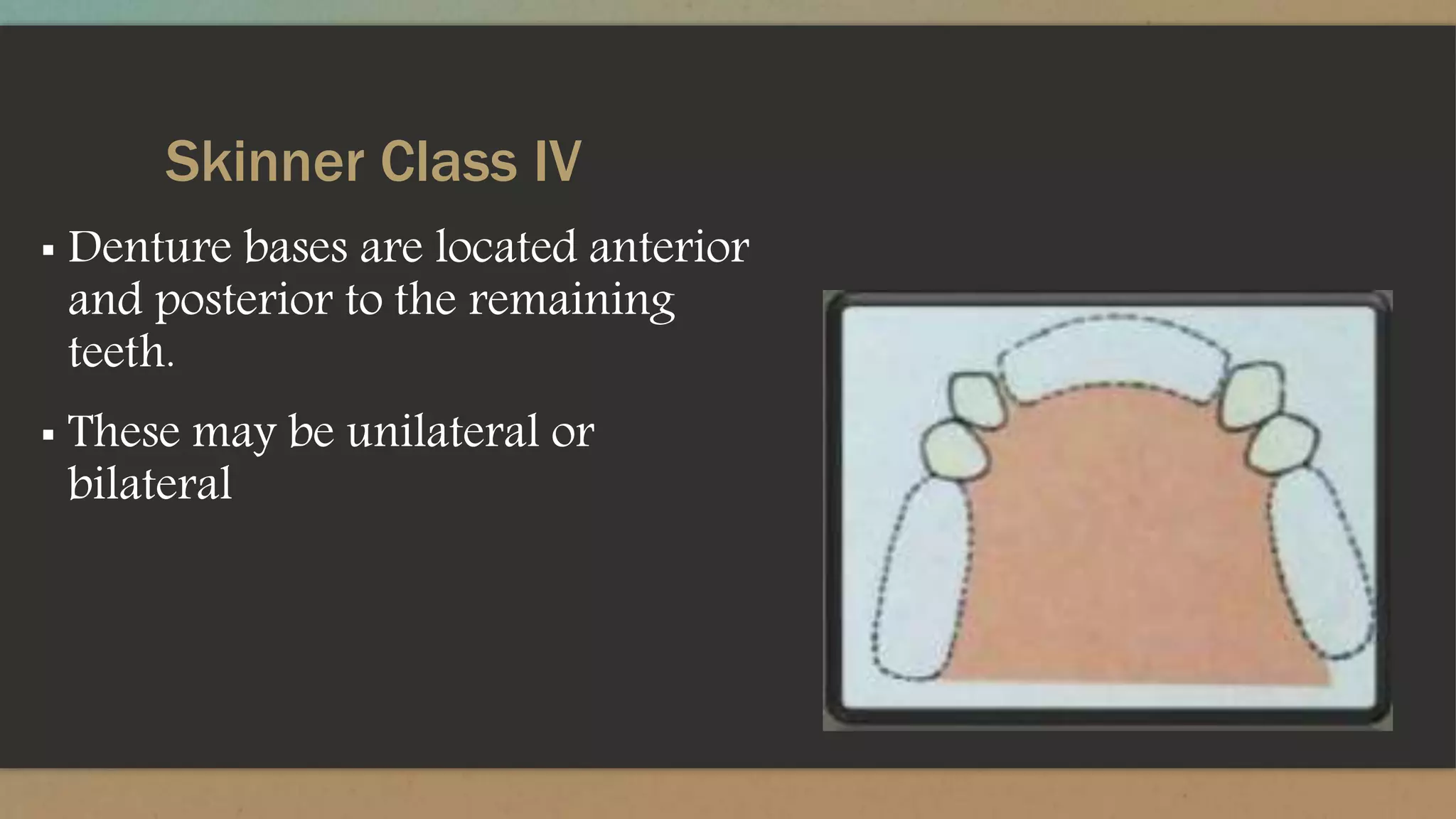 Classification of rpd (lecture) | PPSX