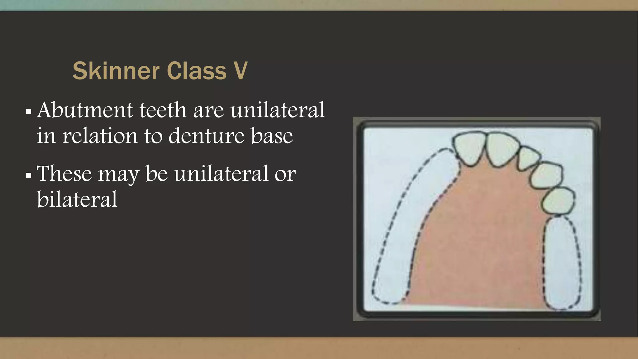 Classification of rpd (lecture) | PPSX
