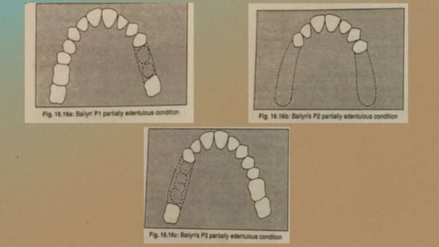 Classification of rpd (lecture) | PPSX