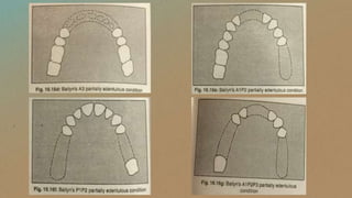 Classification of rpd (lecture) | PPSX
