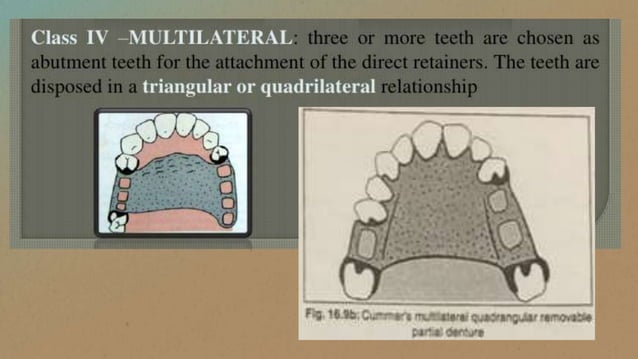 Classification of rpd (lecture) | PPSX