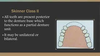 Classification of rpd (lecture) | PPSX