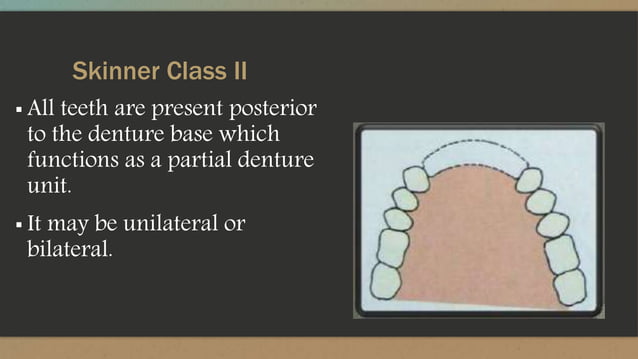 Classification of rpd (lecture) | PPSX