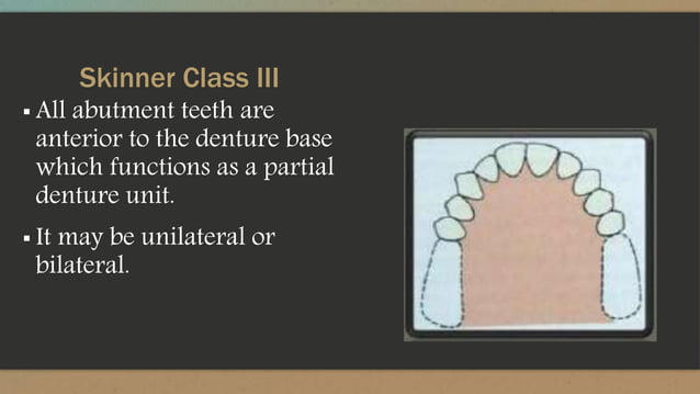 Classification of rpd (lecture) | PPSX