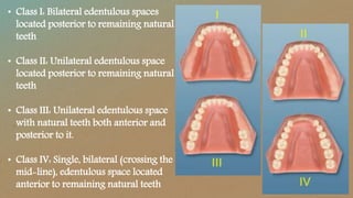 Classification of rpd (lecture) | PPSX