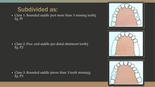 Classification of rpd (lecture) | PPSX