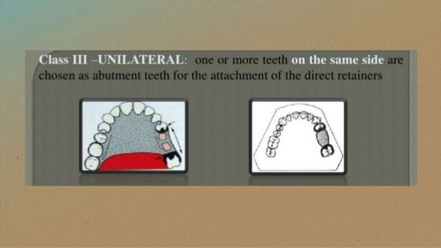 Classification of rpd (lecture)