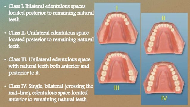 Classification of rpd (lecture)