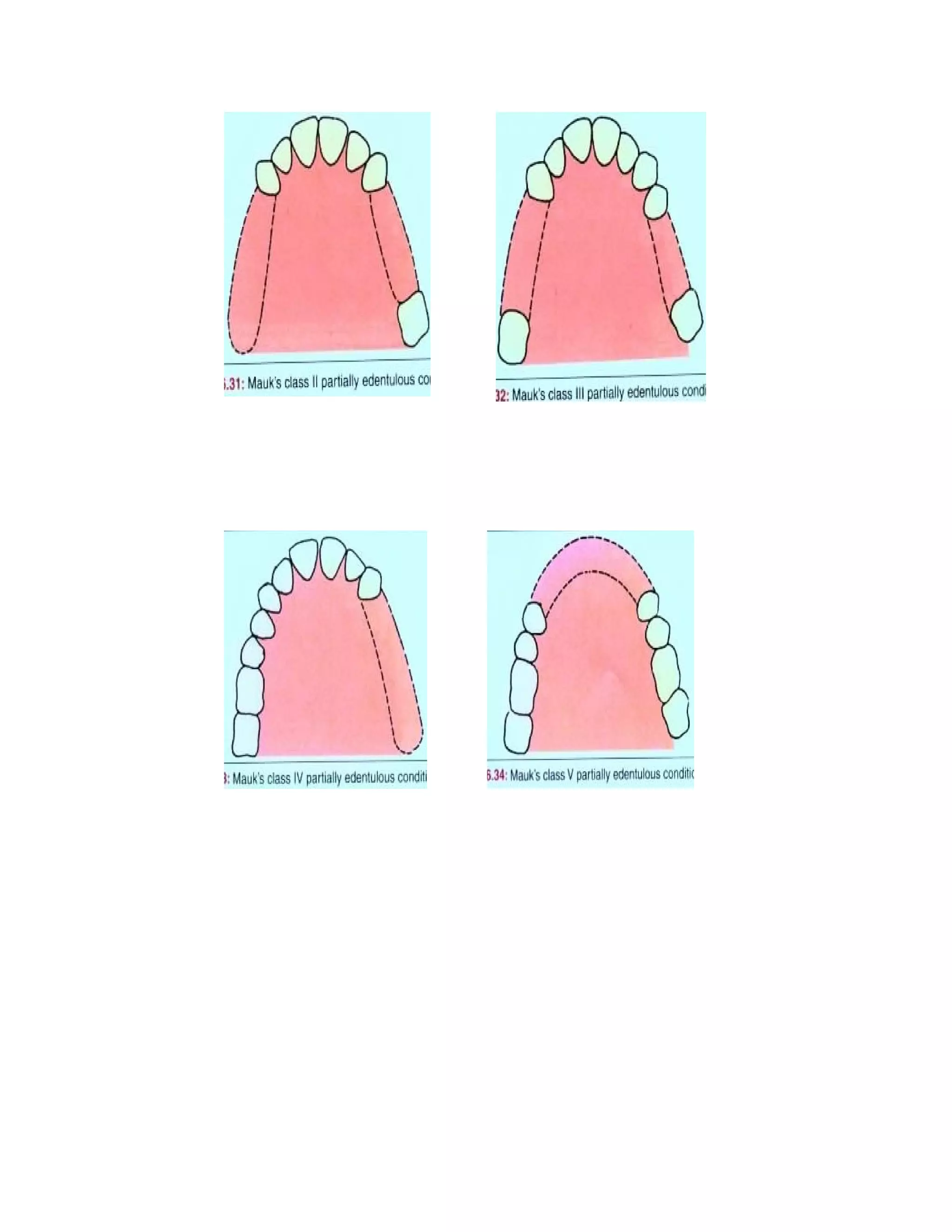 Classification of RPD/cosmetic dentistry course by Indian dental ...