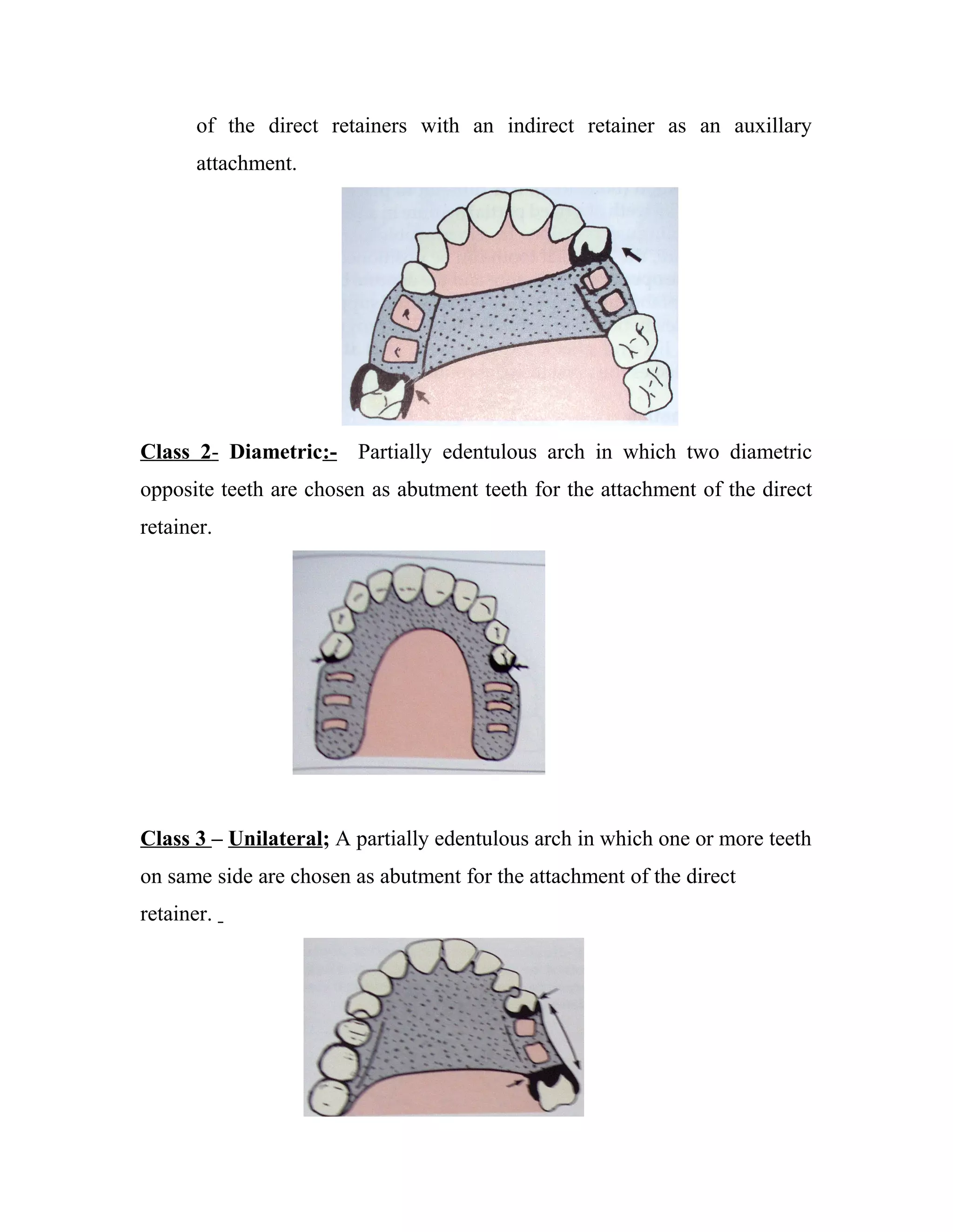 Classification of RPD/cosmetic dentistry course by Indian dental ...