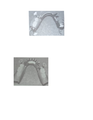 Classification of RPD/cosmetic dentistry course by Indian dental ...