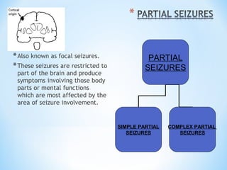 Simple Partial Seizure