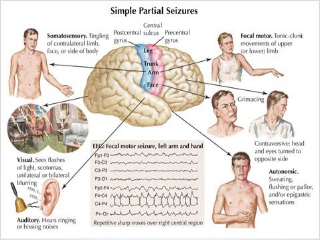 Classification of seizures