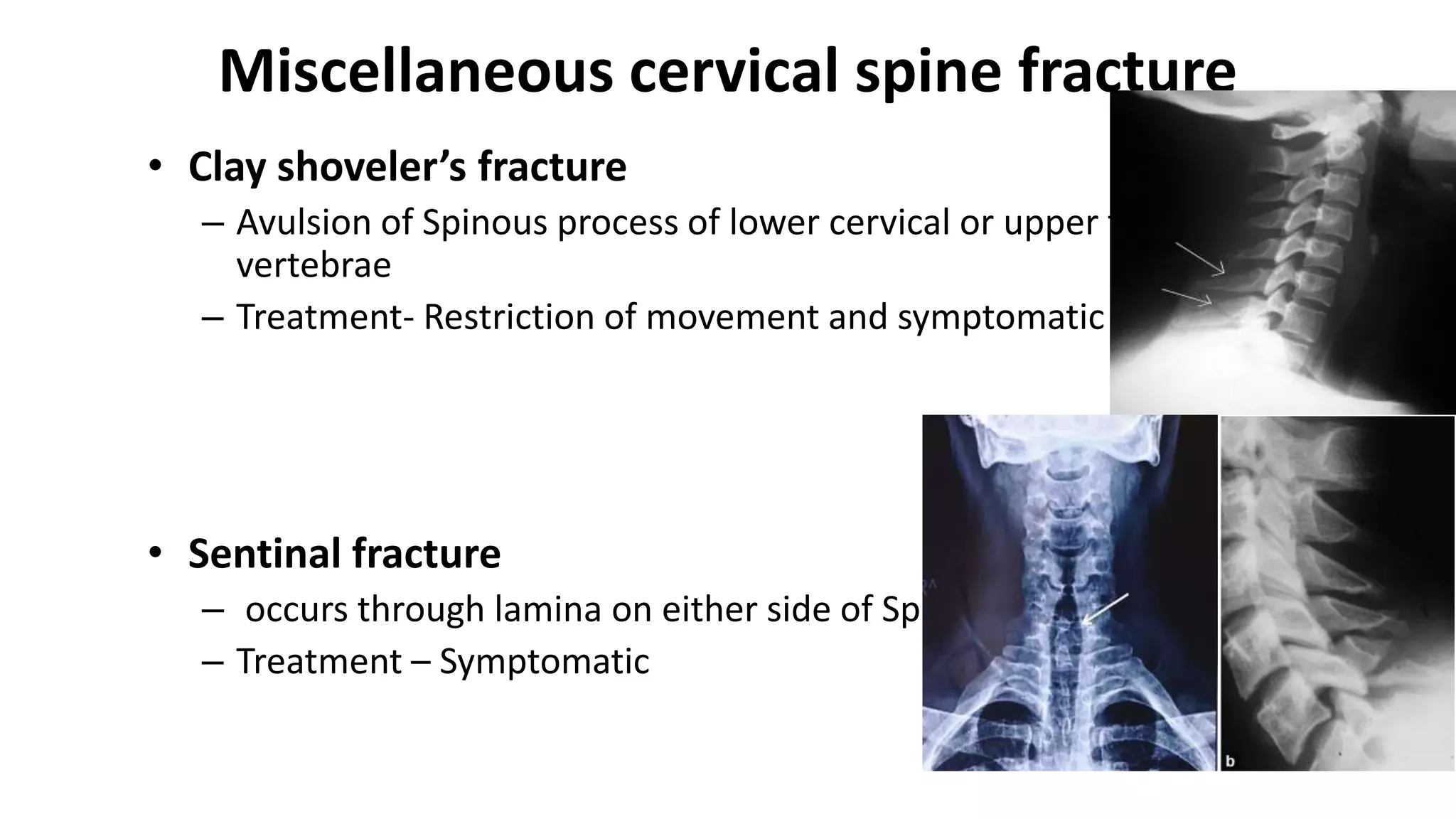 Classification of spinal fracture | PPTX
