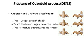 Classification of spinal fracture | PPTX