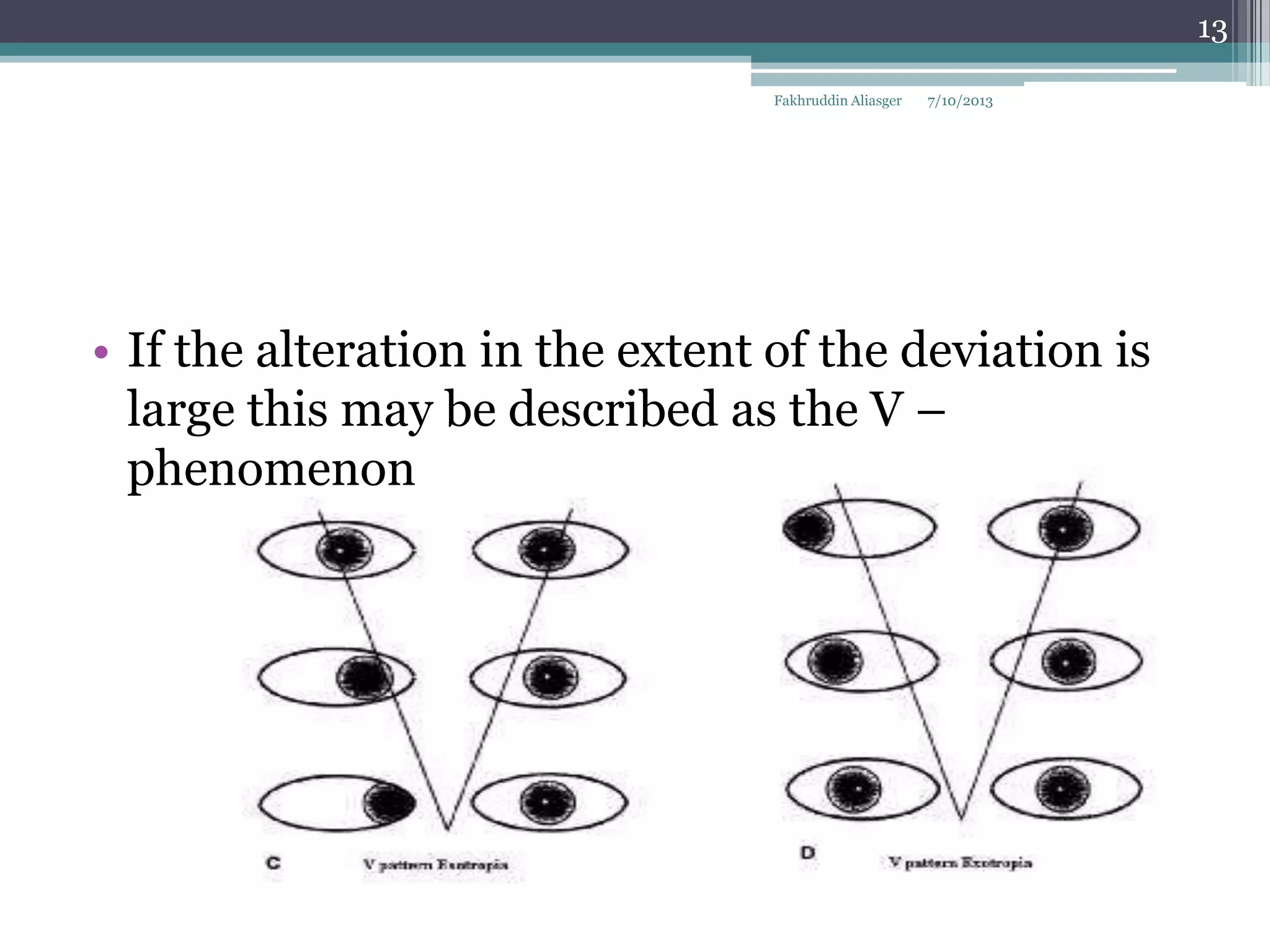 Classification of squint | PPTX