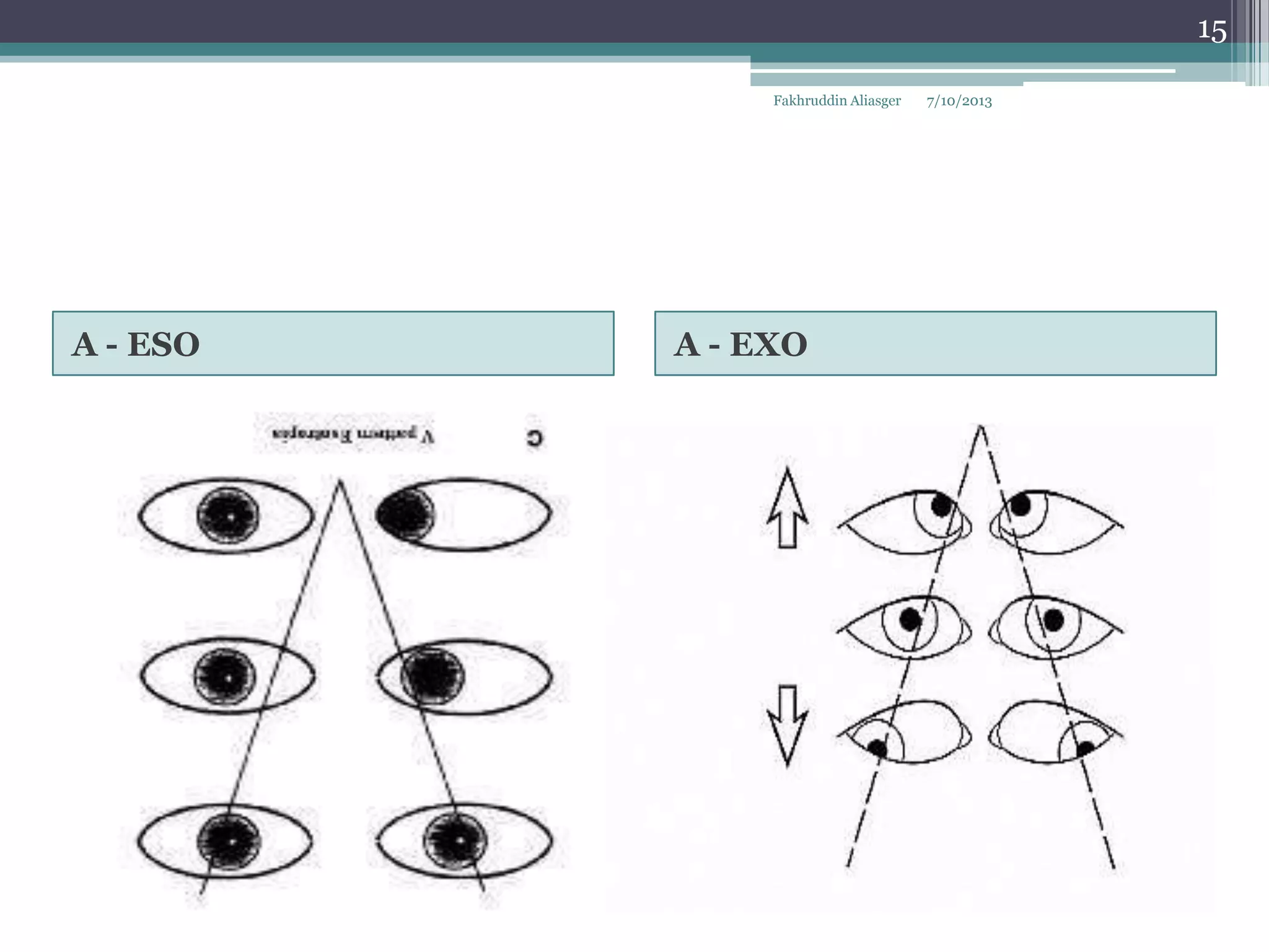 Classification of squint | PPTX