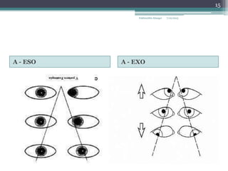 Classification of squint | PPTX
