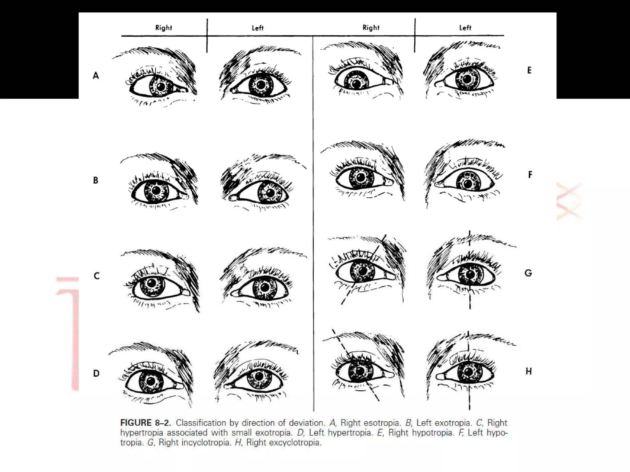 Classification of strabismus | PDF
