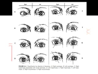 Classification of strabismus | PDF