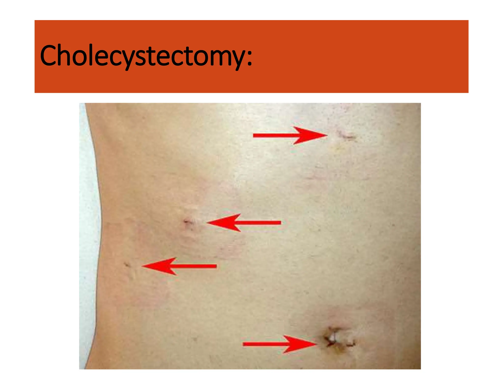 Classification of surgical wounds based on contamination | PPTX
