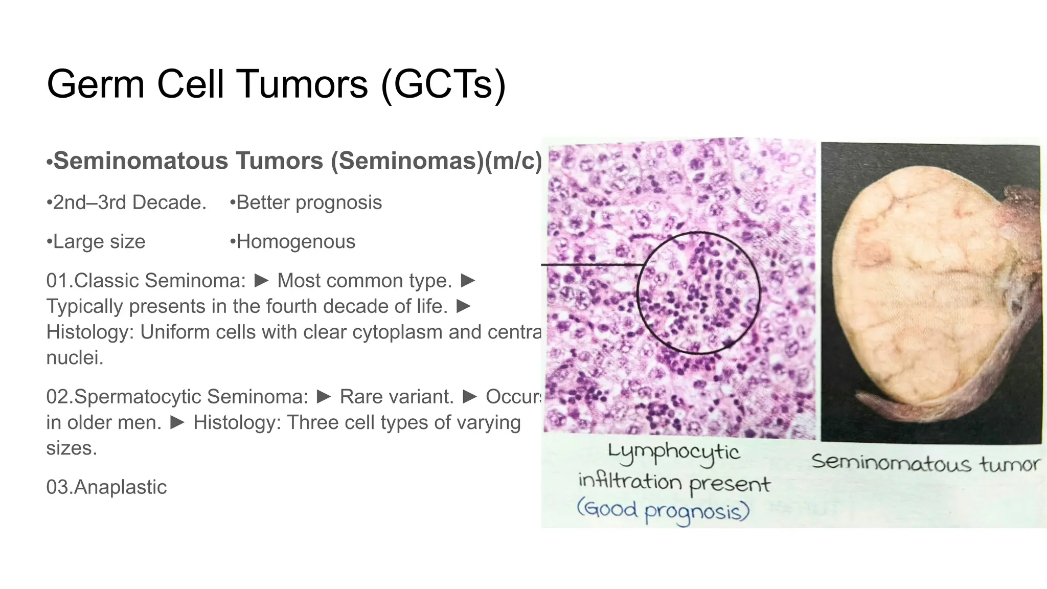 Classification of Testicular tumor and Germcell tumor.pptx