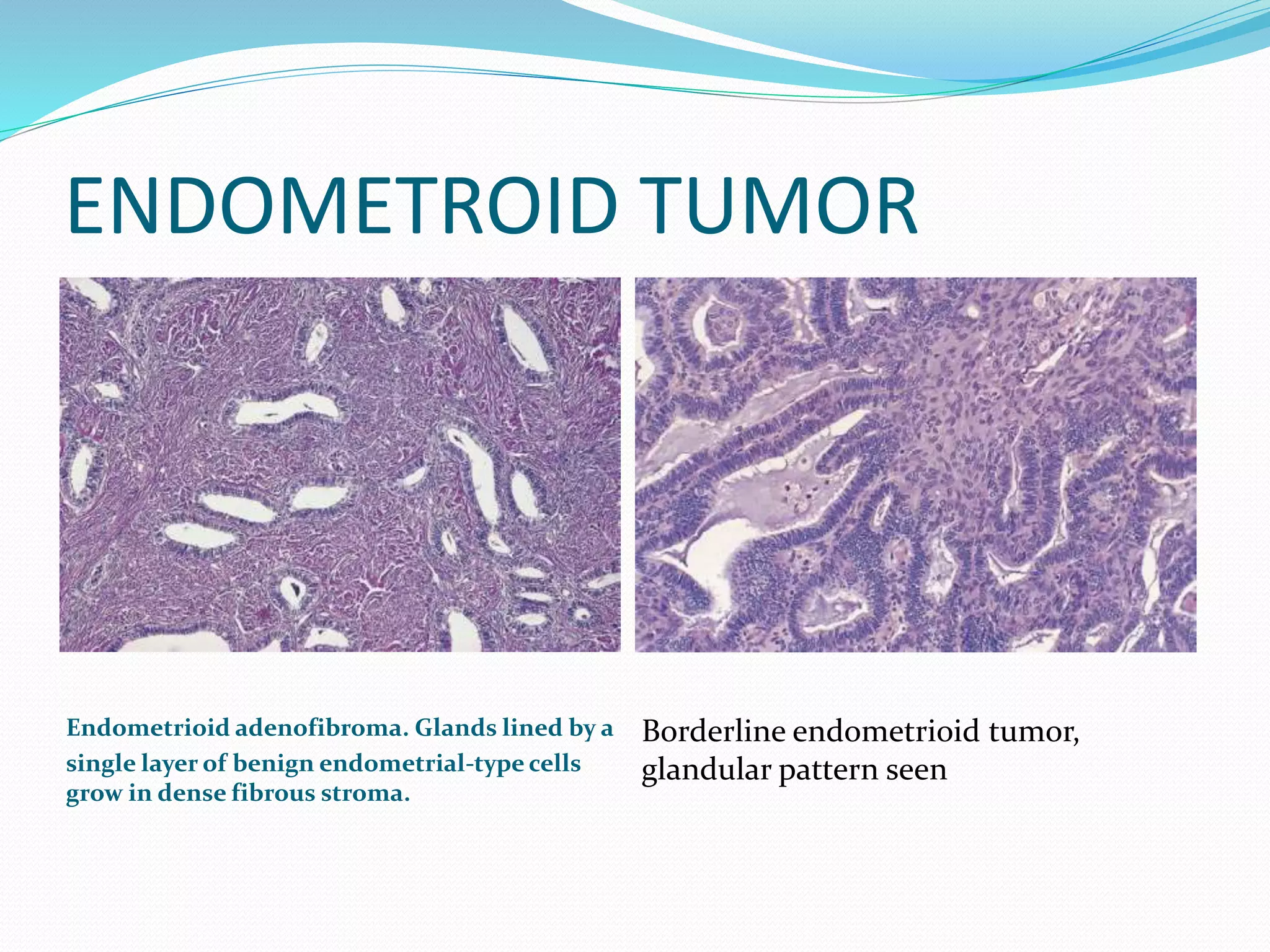 Classification of the tumors of the ovary | PPTX