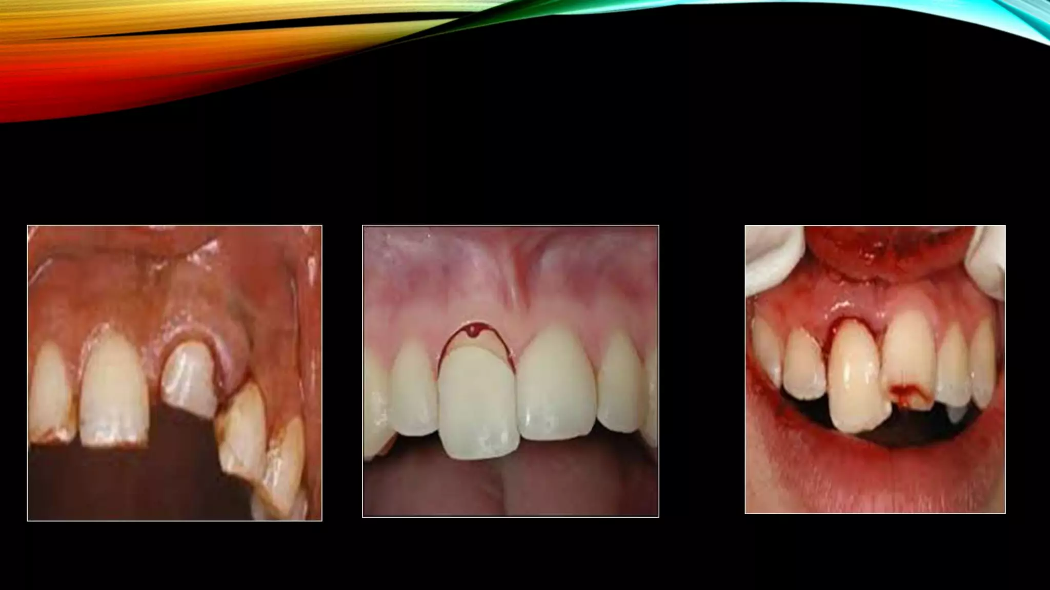 Classification of traumatic injuries to anterior teeth - andreasen's ...