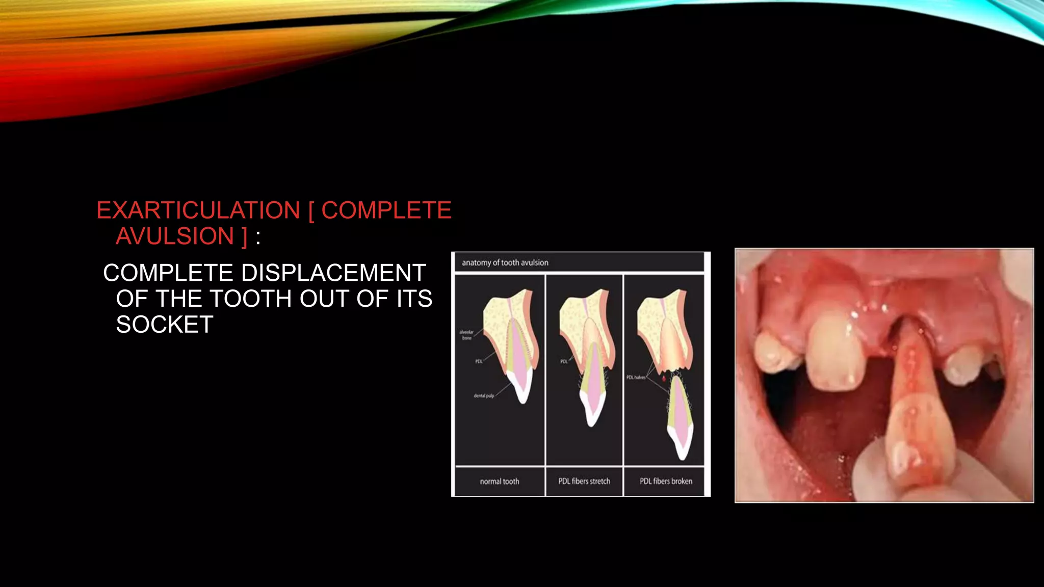 Classification of traumatic injuries to anterior teeth - andreasen's ...