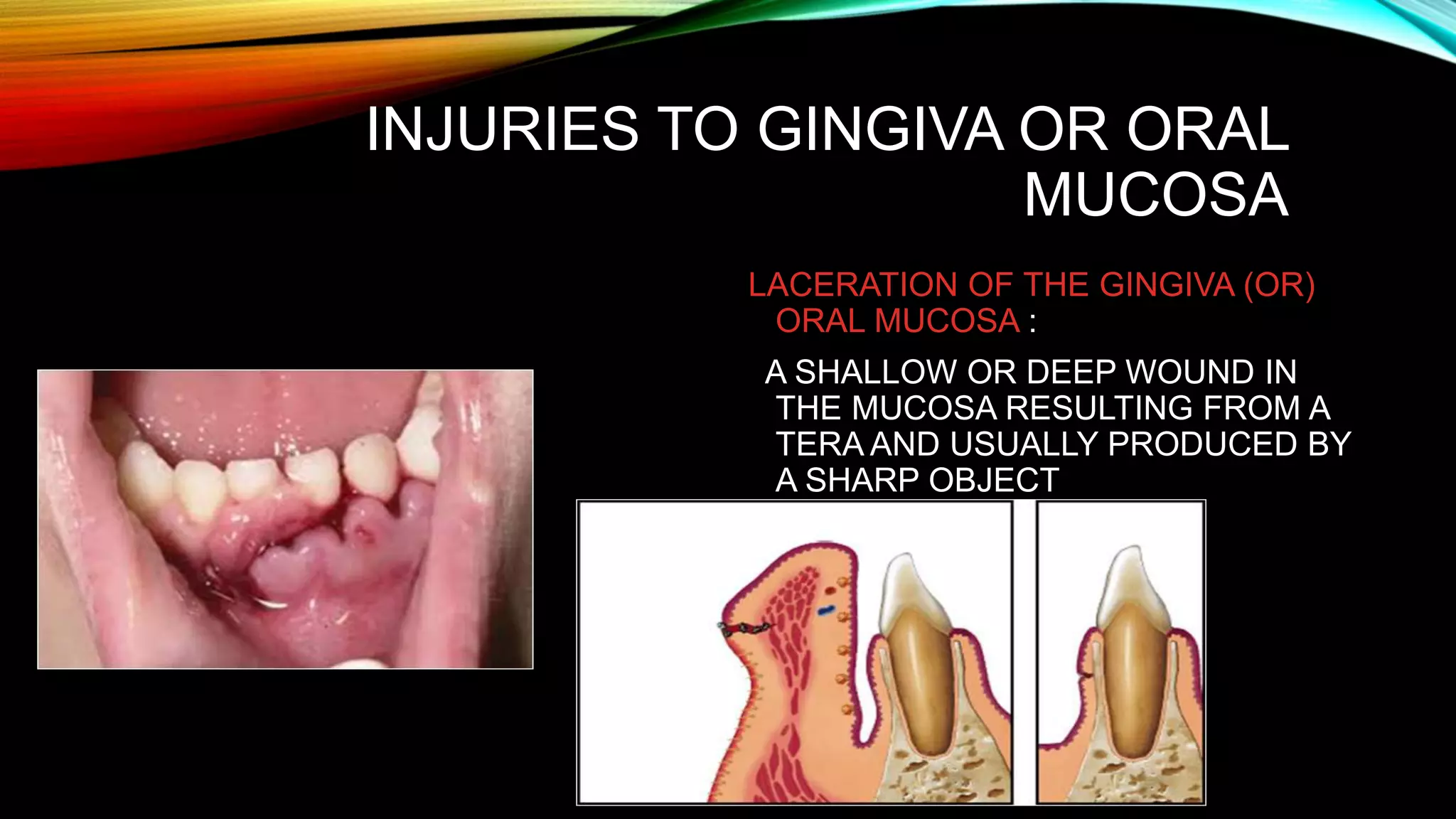 Classification of traumatic injuries to anterior teeth - andreasen's ...