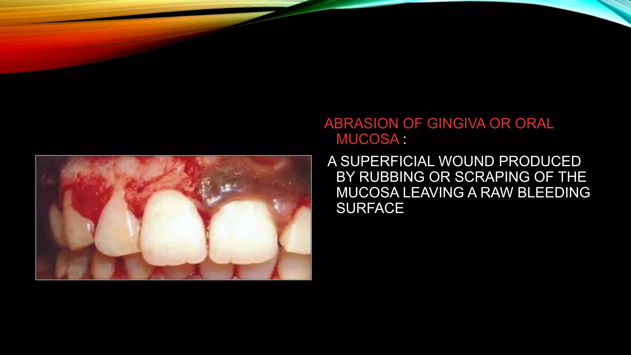Classification of traumatic injuries to anterior teeth - andreasen's ...