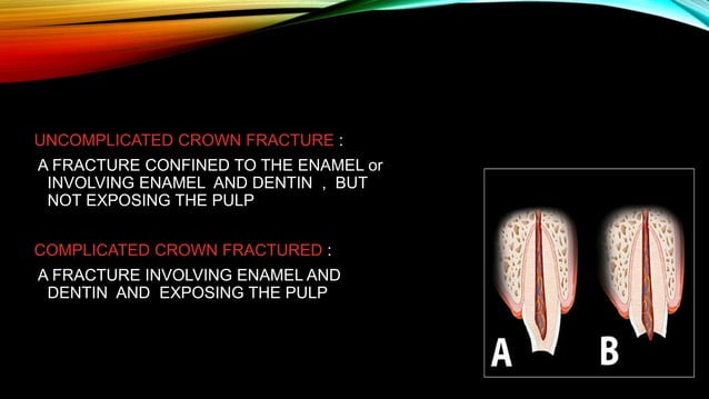 Classification of traumatic injuries to anterior teeth - andreasen's ...