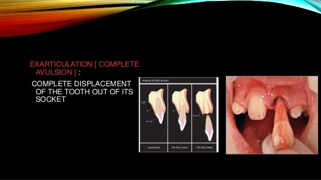 Classification of traumatic injuries to anterior teeth - andreasen's