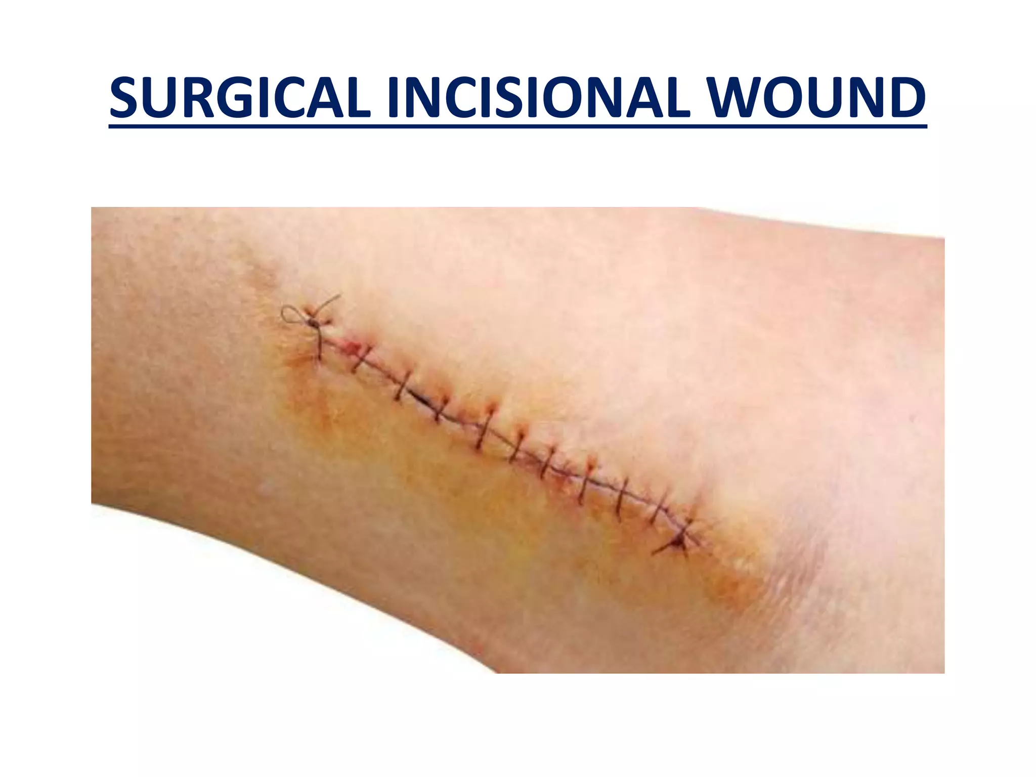Classification of wounds | PPTX | First Aid | Injuries