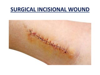 Classification of wounds | PPTX