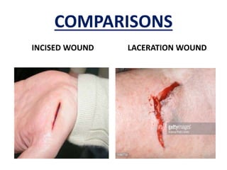Classification of wounds | PPTX | First Aid | Injuries