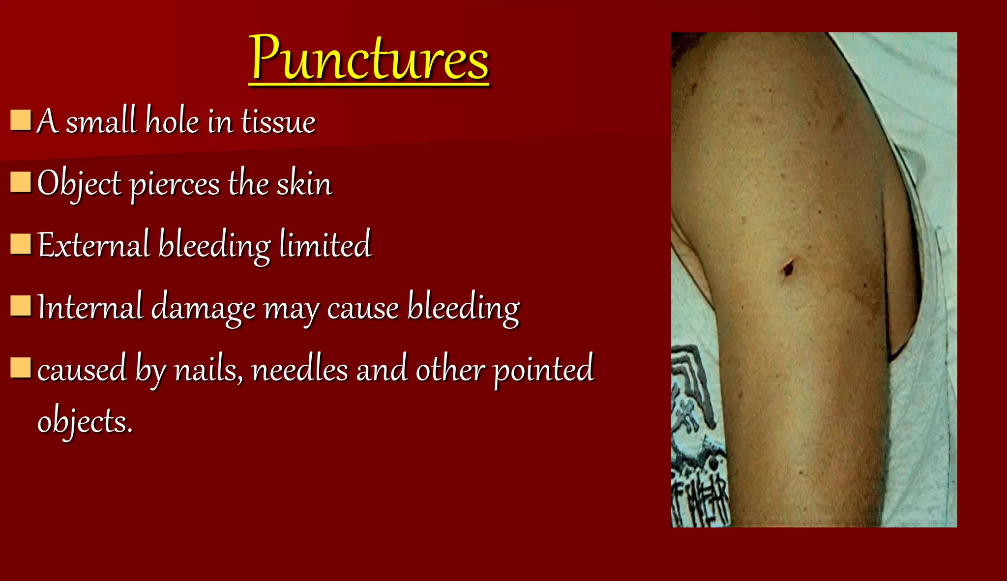 Classification of wounds | PPT | First Aid | Injuries