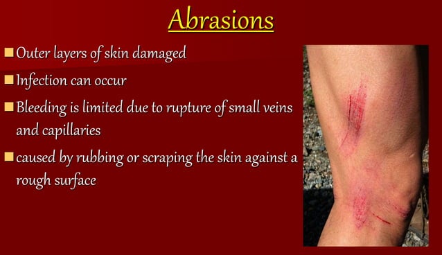 Classification of wounds | PPT