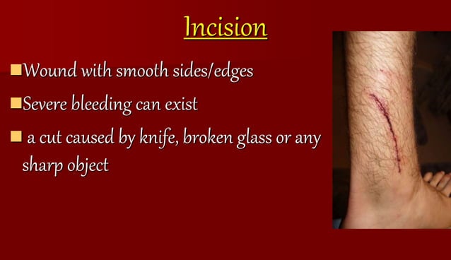 Classification of wounds | PPT