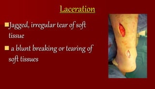 Classification of wounds | PPT | First Aid | Injuries