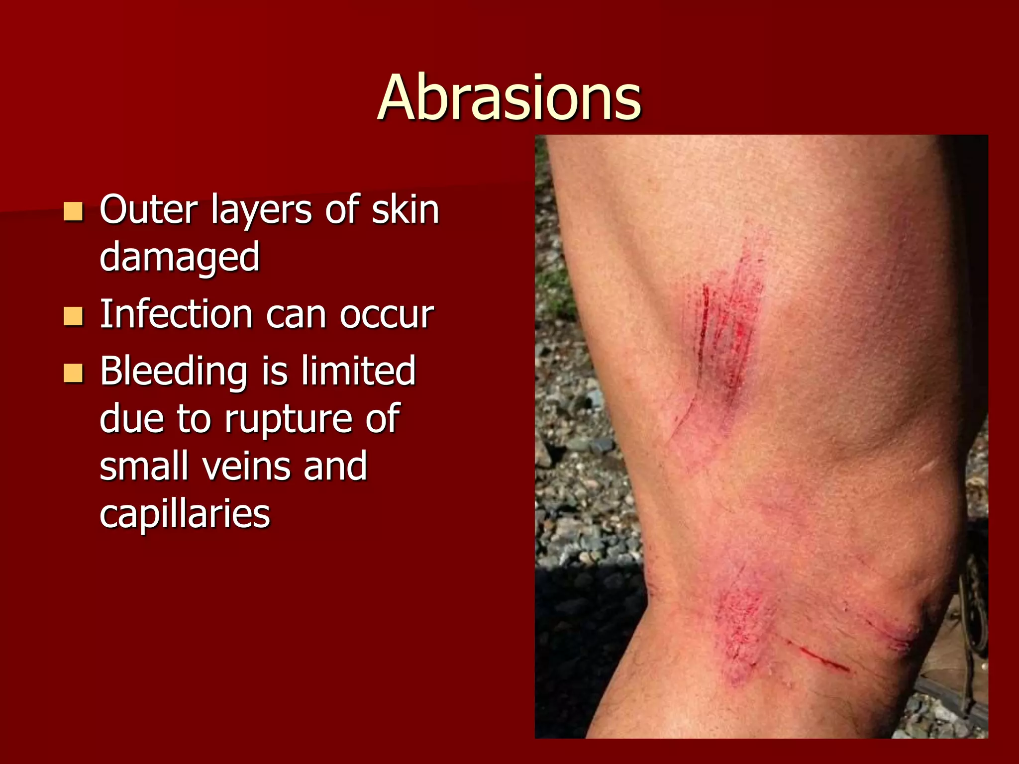 Classification of Wounds.ppt