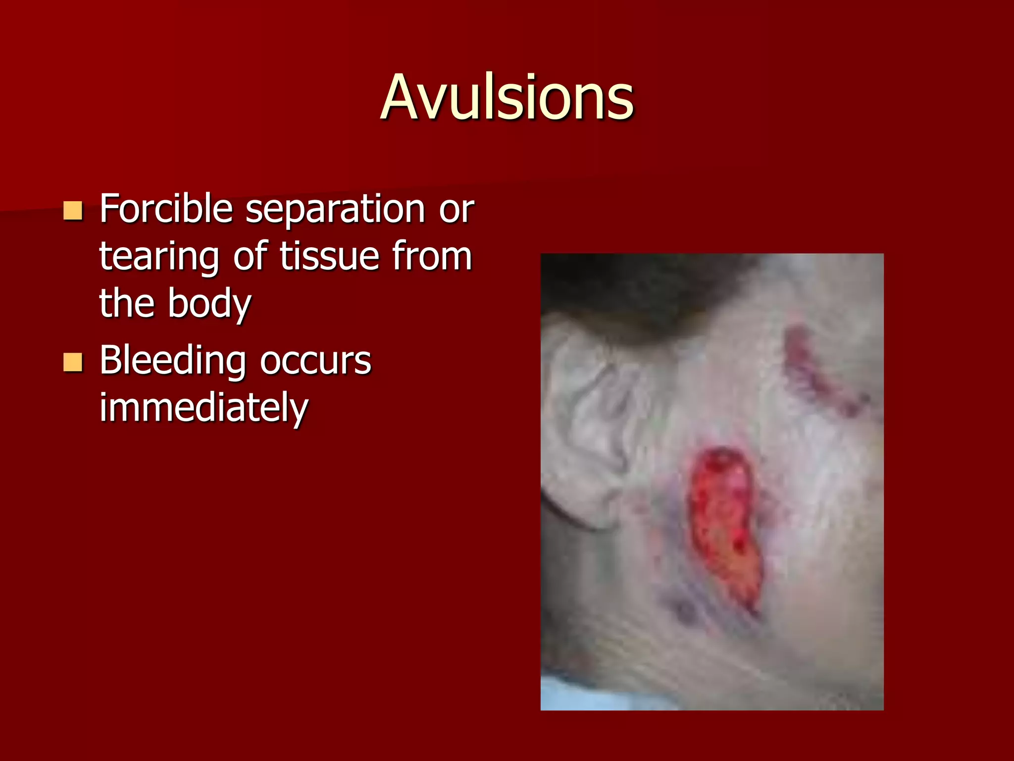 Classification of Wounds.ppt