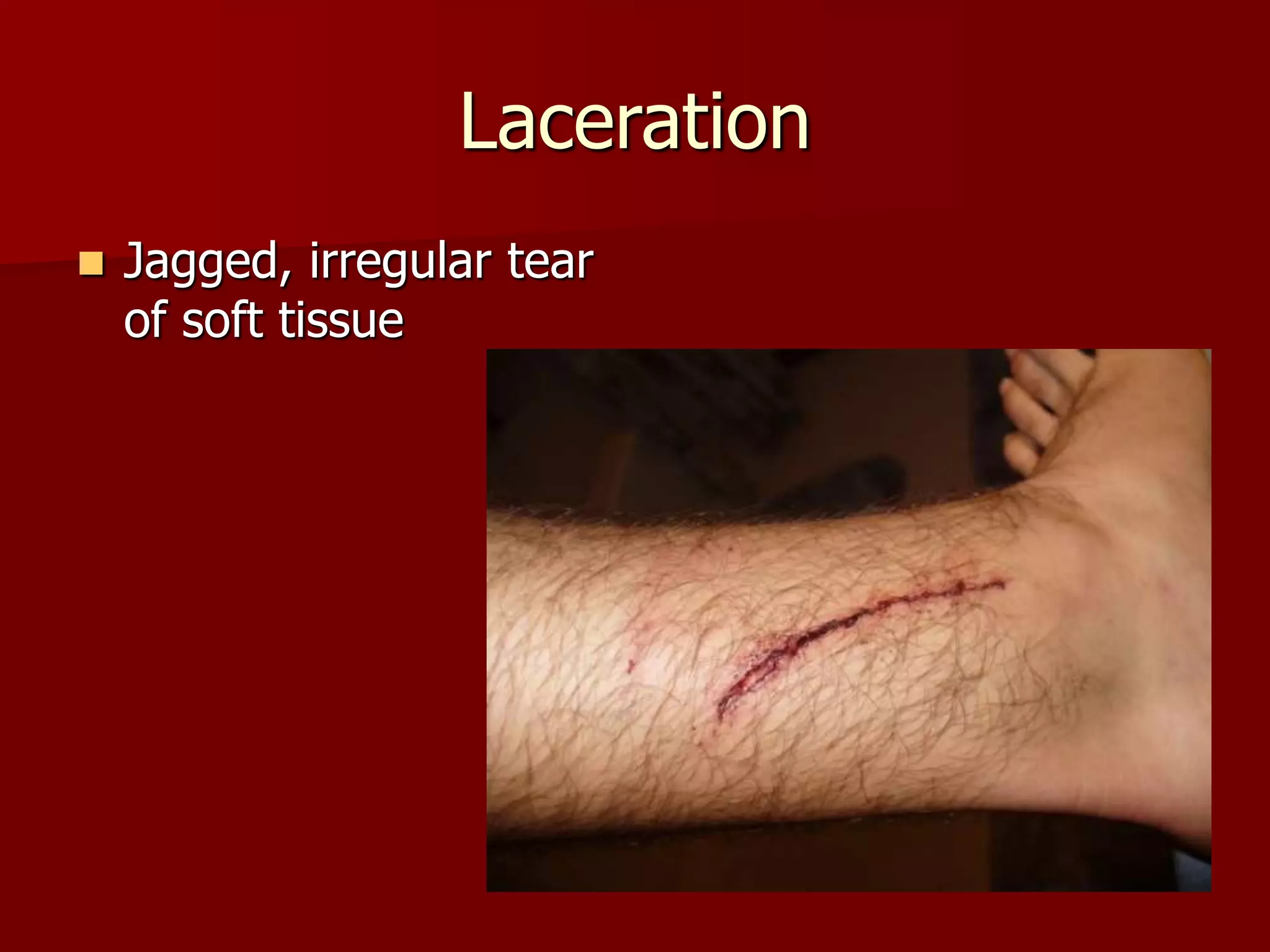 Classification of Wounds.ppt