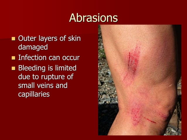 Classification of Wounds.ppt