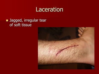 Classification of Wounds.ppt